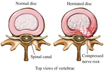 Herniated disc (Discopathy) – Physiotherapy Service London